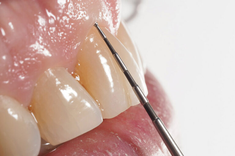 ¿Cuánto tarda en cicatrizar un injerto de encía? | Dr. Javier Sola