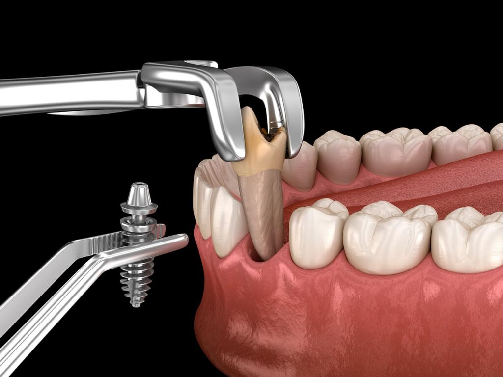Extracción dental en Valladolid | Clínica Dr. Sola